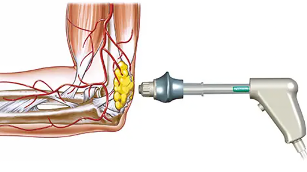 What is the Difference Between Shockwave Therapy vs Laser Therapy?